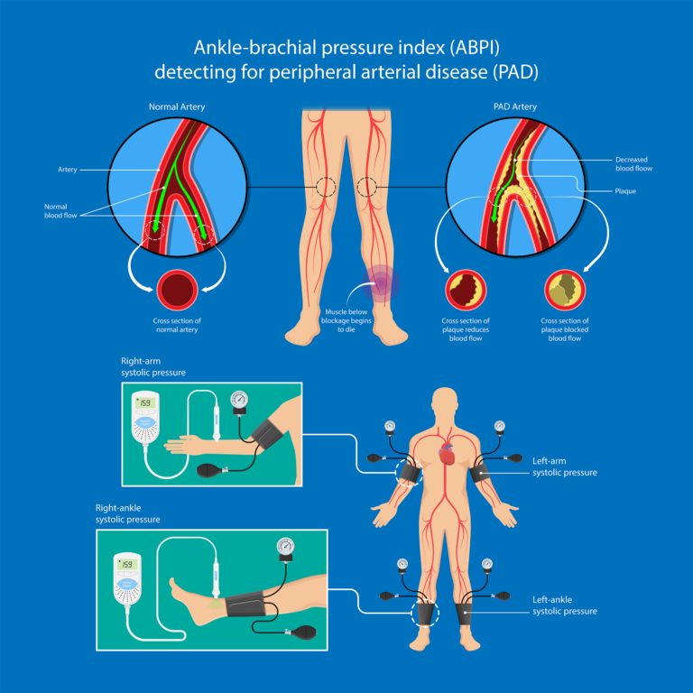Peripheral Arterial Disease (PAD) | Karen Owoc - Live Younger Longer