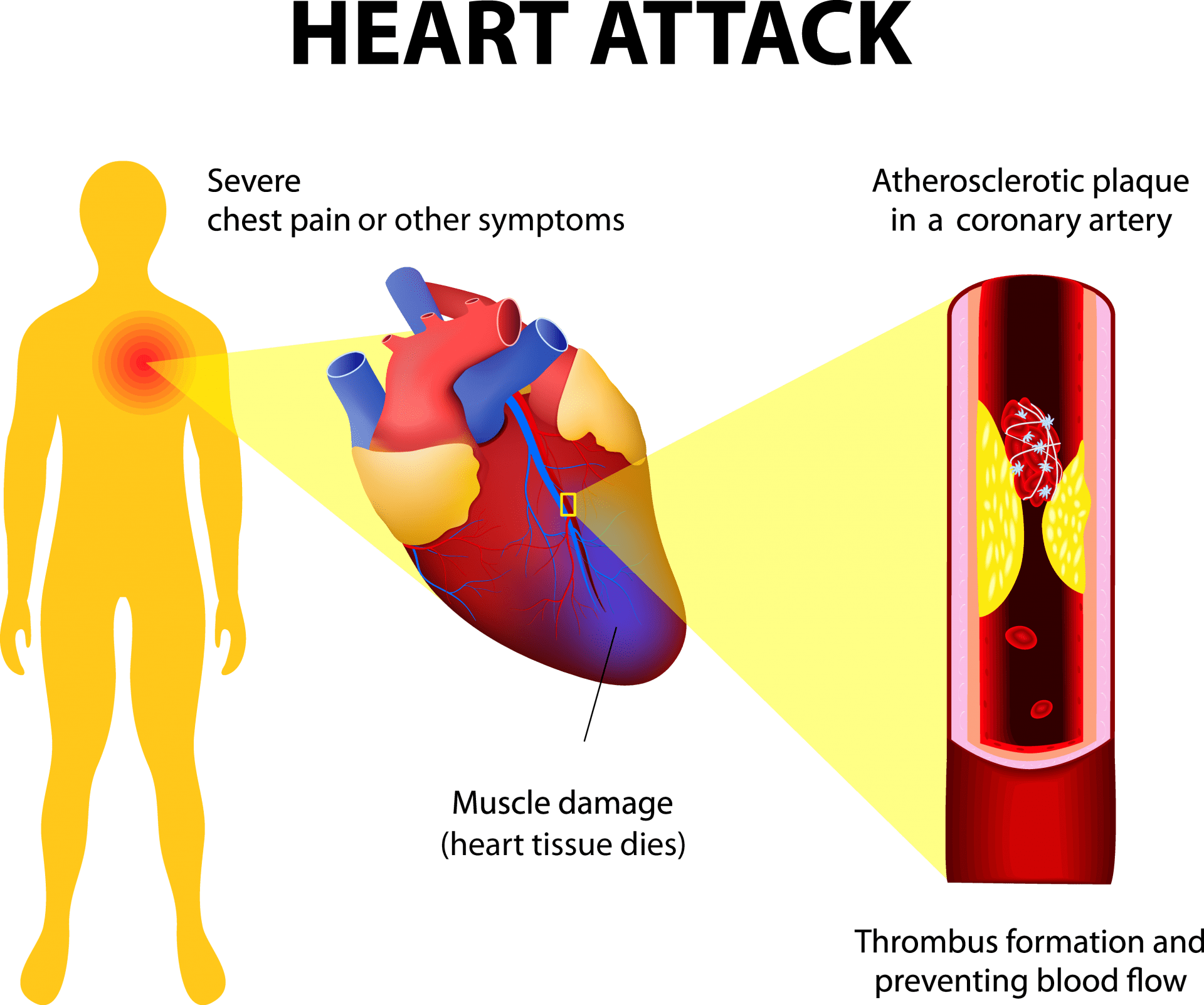 Heart Attack! First Aid Quiz | Karen Owoc - Live Younger Longer